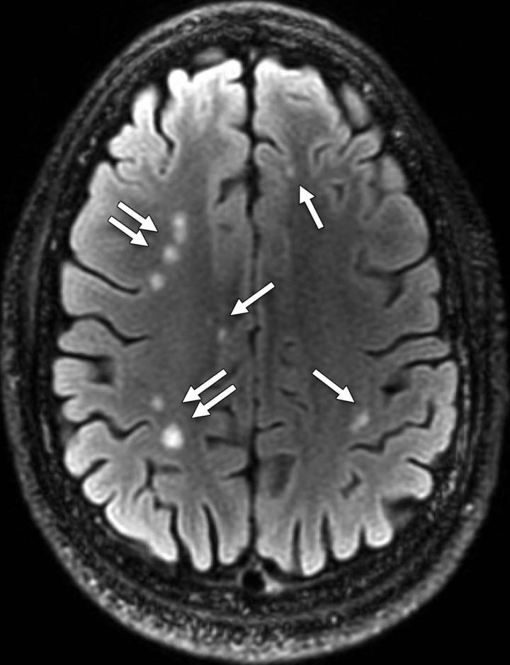 MRI Shows 'Brain Scars' In Mil [IMAGE] | EurekAlert! Science News Releases