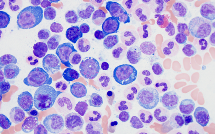 Treating a mysterious illness | EurekAlert!