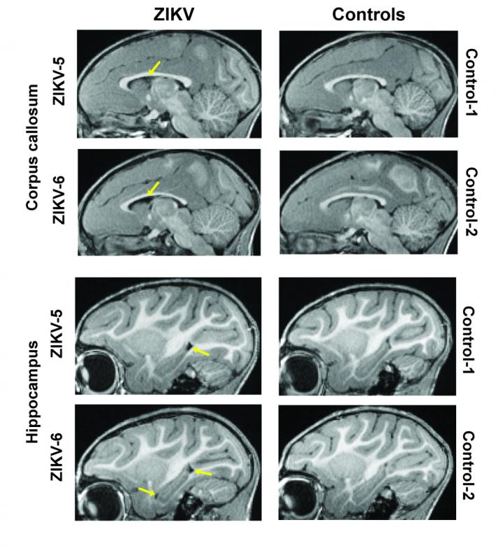 Zika Infection Post-Birth Alters Brain Struct | EurekAlert!