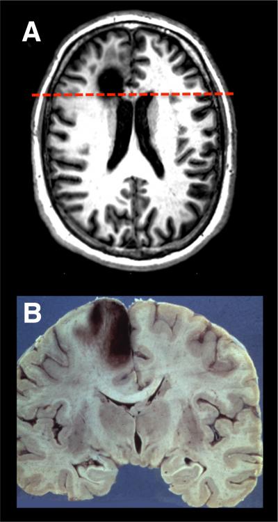 Lesions to Medial Prefrontal C [IMAGE] | EurekAlert! Science News Releases