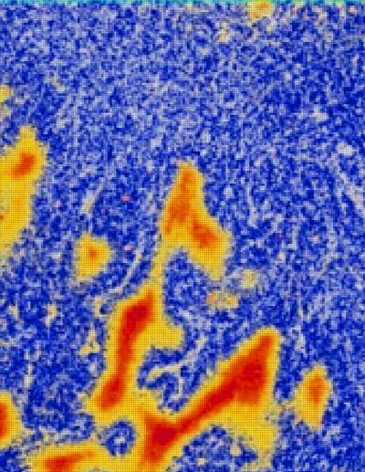 Src Protein On The Scene In Kidney Cancer Eurekalert