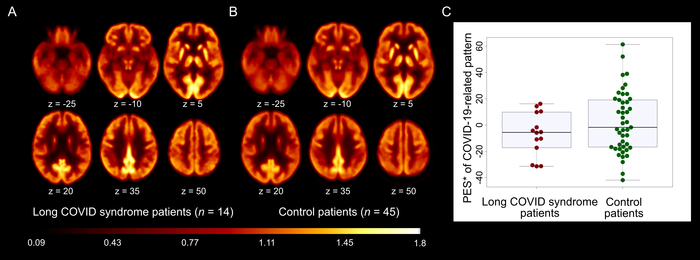 Molecular imaging suggests Long-COVID symptom | EurekAlert!