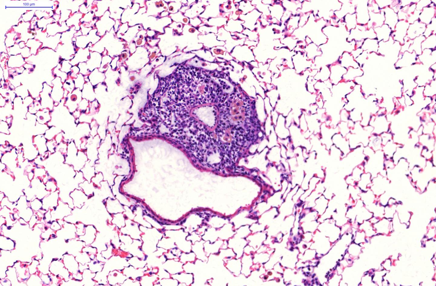 COPD-associated inflammation halted in model | EurekAlert!