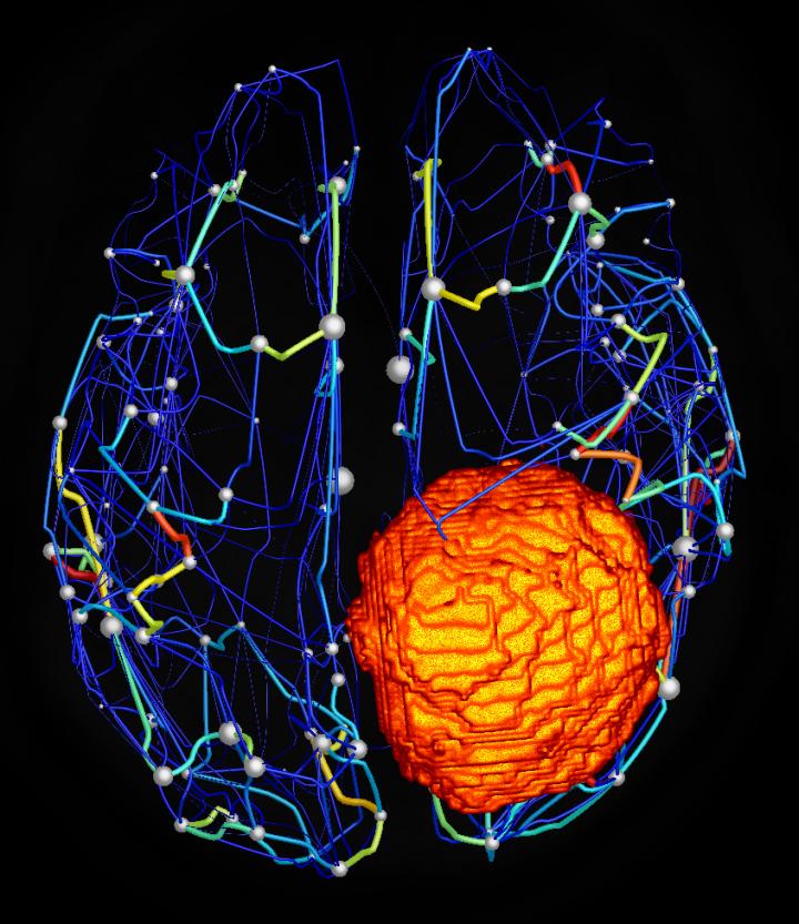 Virtual brain could aid surgical planning | EurekAlert!