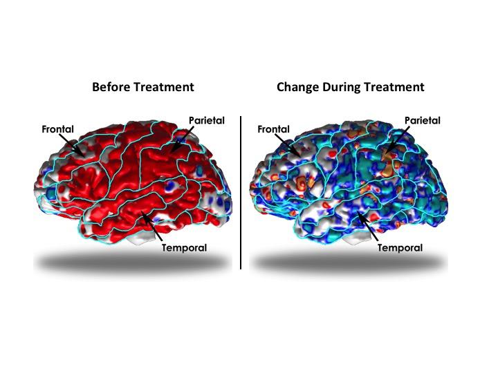 Brain Scans of Chronically Dep [IMAGE] | EurekAlert! Science News Releases