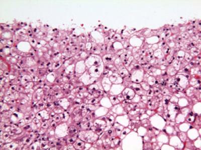 NASH [IMAGE] | EurekAlert! Science News Releases