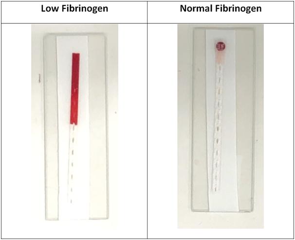 Example of Fibrinogen Diagnost [IMAGE] | EurekAlert! Science News Releases