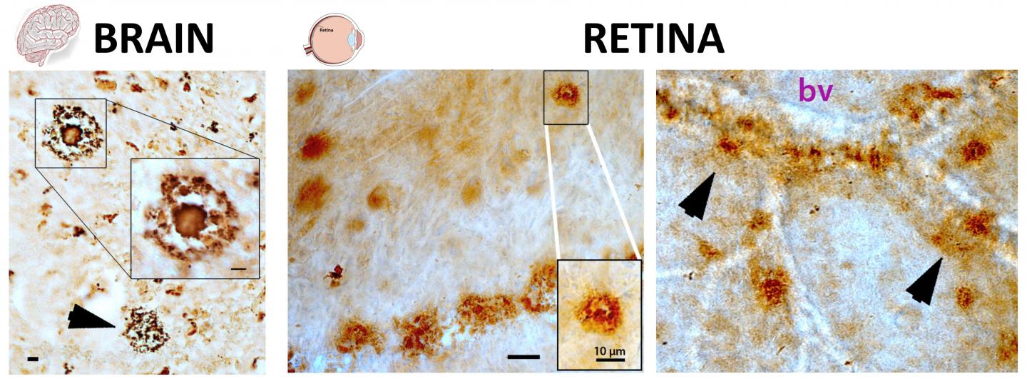 Pathological Hallmarks of AD [IMAGE] | EurekAlert! Science News Releases