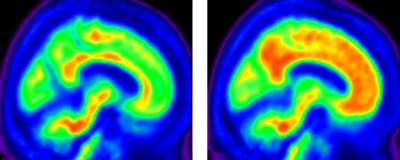 Brain Scans of Healthy Adults [IMAGE] | EurekAlert! Science News Releases