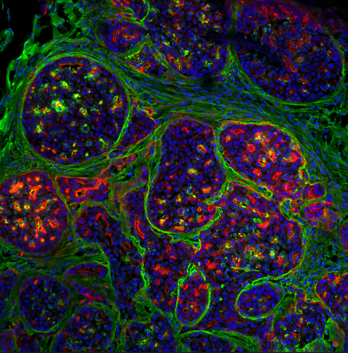 Breast cancer tumour basement [IMAGE] | EurekAlert! Science News Releases