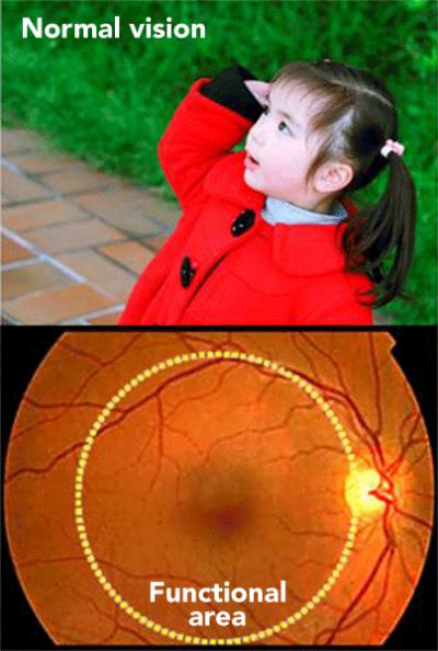 Vision of Patients with Retini [IMAGE] | EurekAlert! Science News Releases