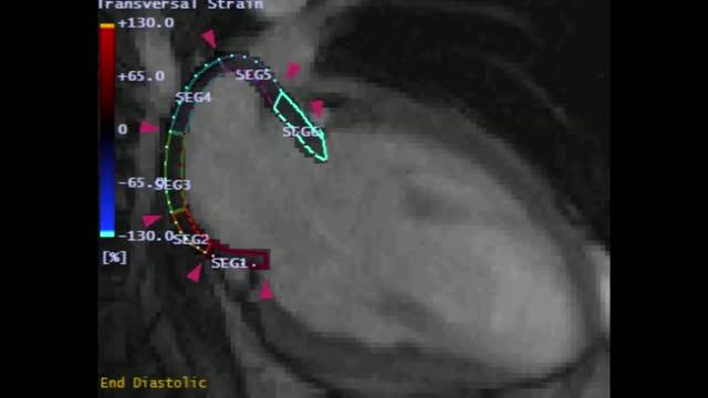 Biomarker predicts success of Afib treatment | EurekAlert!