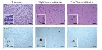 Chloride Imbalance May Explain Tumor-Linked S | EurekAlert!