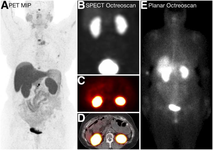 Example of SSTR PET [IMAGE] | EurekAlert! Science News Releases