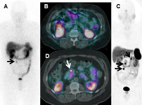 Ga-68 DOTATATE PET/CT v. In-11 [IMAGE] | EurekAlert! Science News Releases