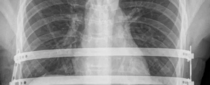 Prosthetic device developed in Brazil improve | EurekAlert!