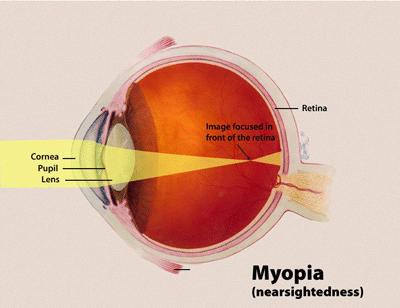 Myopia [IMAGE] | EurekAlert! Science News Releases