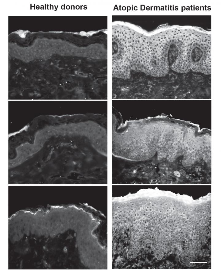 How High Humidity Levels Help Skin Ailments ( | EurekAlert!