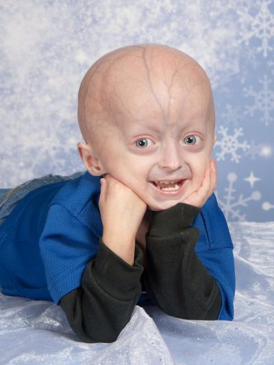 Babies With Progeria
