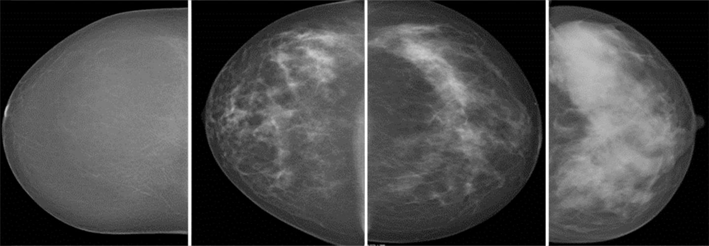Mammograms Showing Volumetric [IMAGE] | EurekAlert! Science News Releases