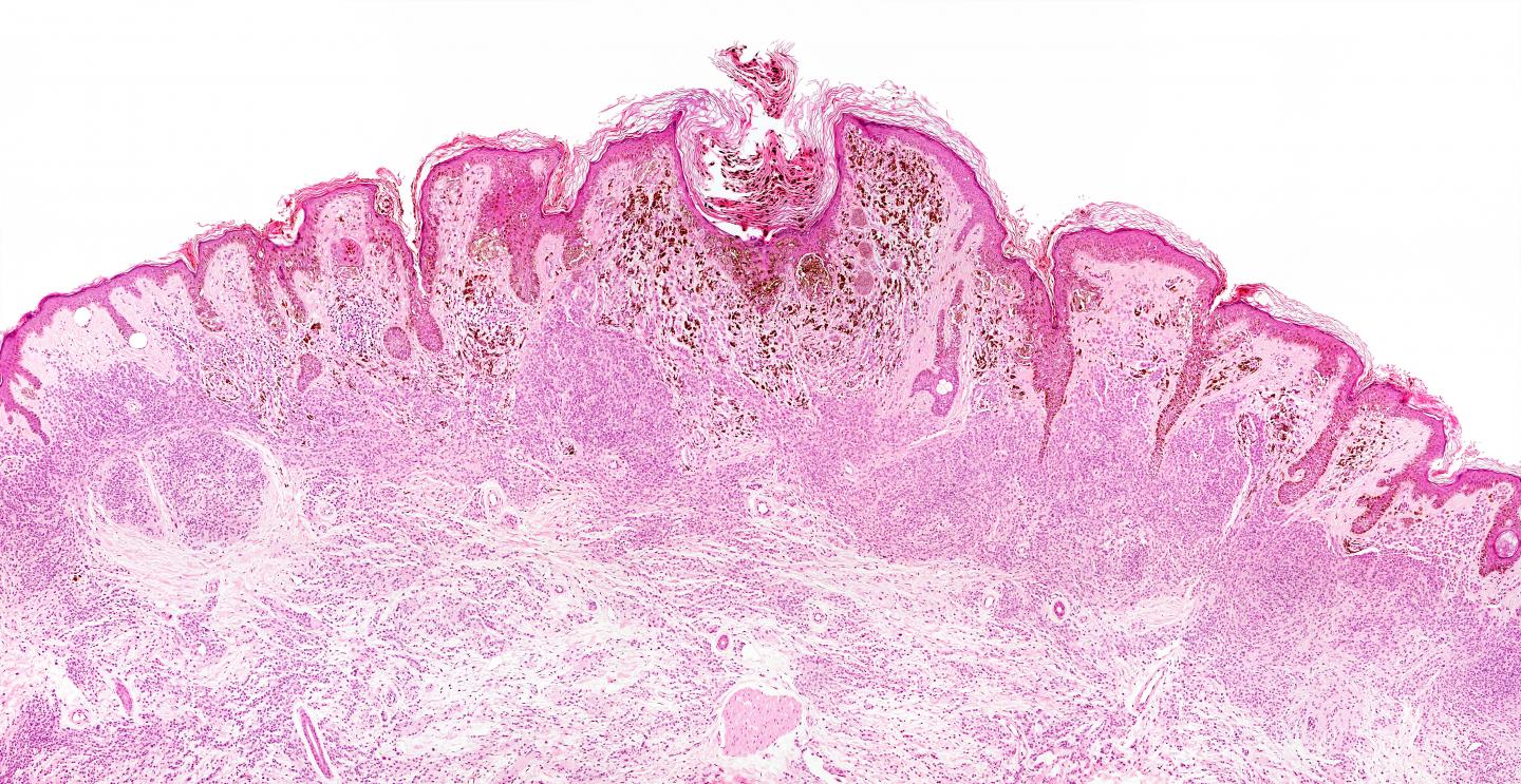 Malignant Melanoma Microscope [IMAGE] | EurekAlert! Science News Releases