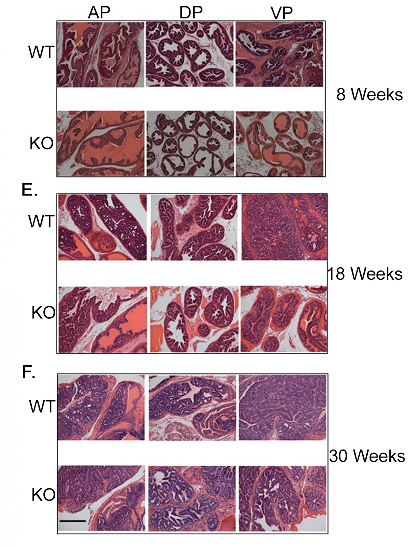 A Diagnostic Marker Also Drives Prostate Canc | EurekAlert!