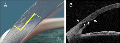 3-D Imaging Guides Femtosecond Laser in Catar | EurekAlert!