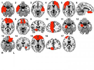 Brain lesions and criminal behavior | EurekAlert!
