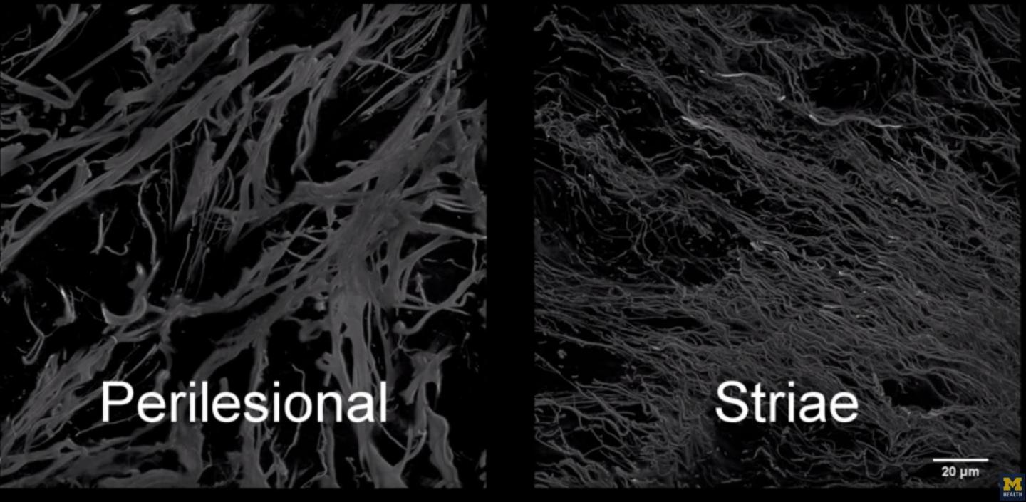 Stretch mark science: What happens to your sk | EurekAlert!