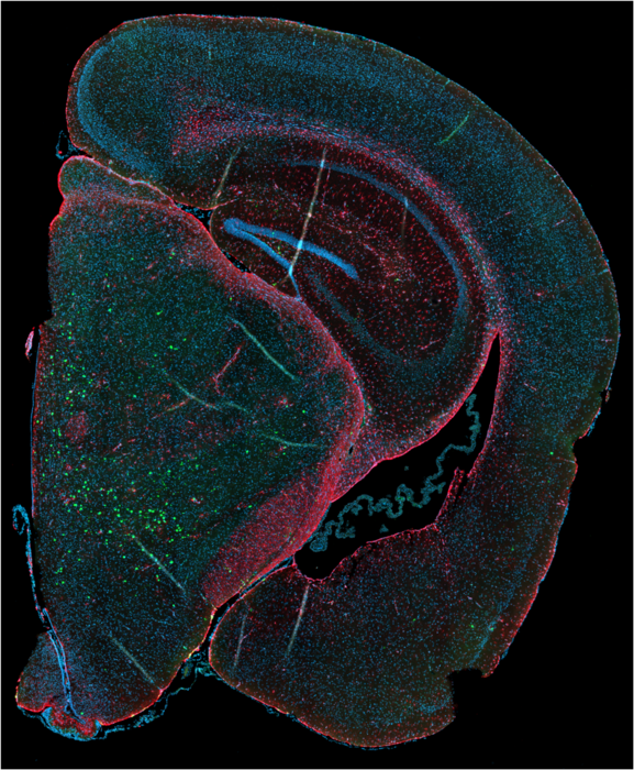 Neuropathological inclusions [IMAGE] | EurekAlert! Science News Releases