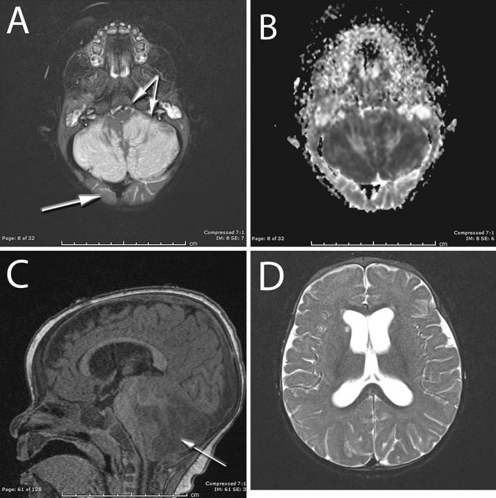 Clinical appearance and unusual imaging findi | EurekAlert!