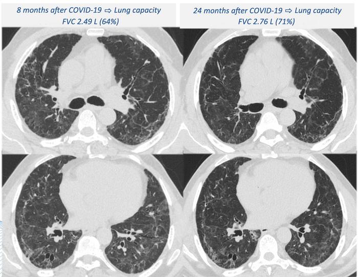 Lung complications can worsen two years after | EurekAlert!