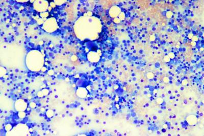 Bone Marrow Slide 1992 [IMAGE] | EurekAlert! Science News Releases