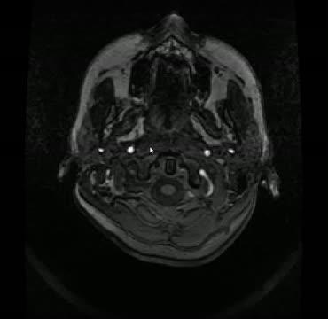 New Insights into Recovering Communication Af | EurekAlert!