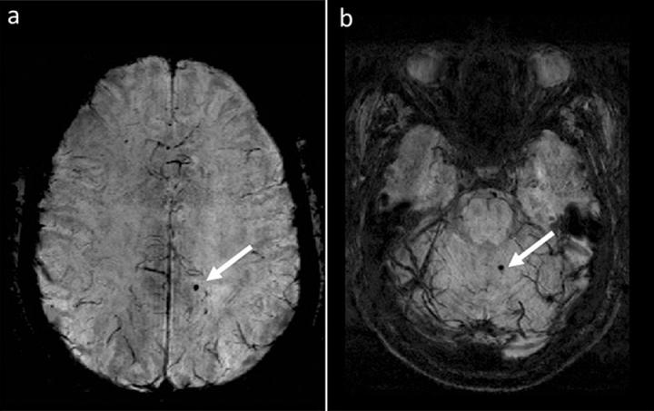 Cerebral microbleeds in MS are associated wit | EurekAlert!
