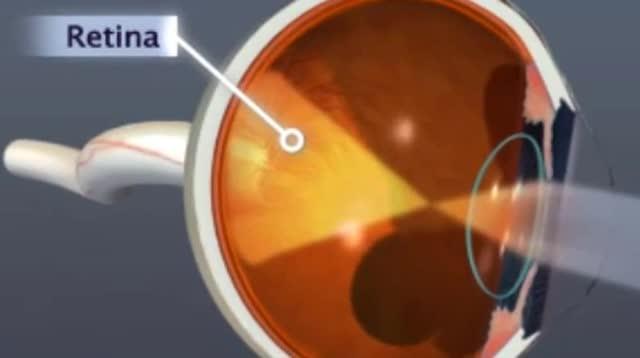 Lucentis effective for proliferative diabetic | EurekAlert!