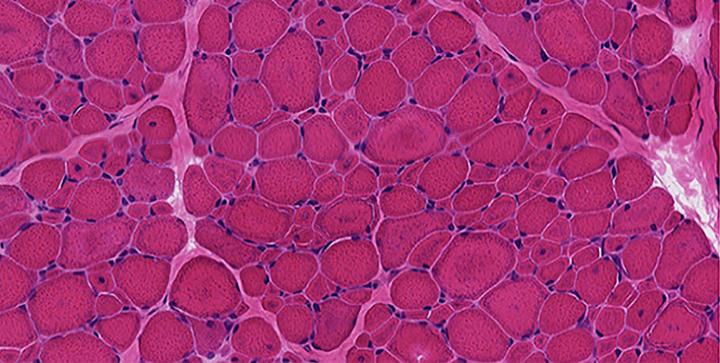 Diseased Muscle Tissue Gene Th [IMAGE] | EurekAlert! Science News Releases