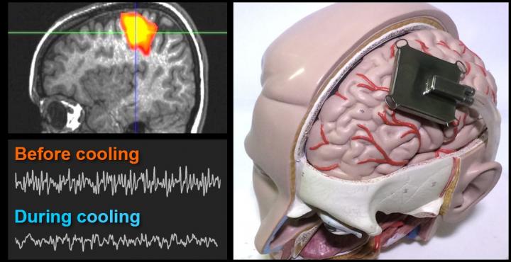 Simulating a brain-cooling treatment that cou | EurekAlert!