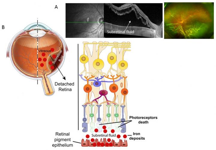 The Link Between Iron and Vision Loss, and a | EurekAlert!