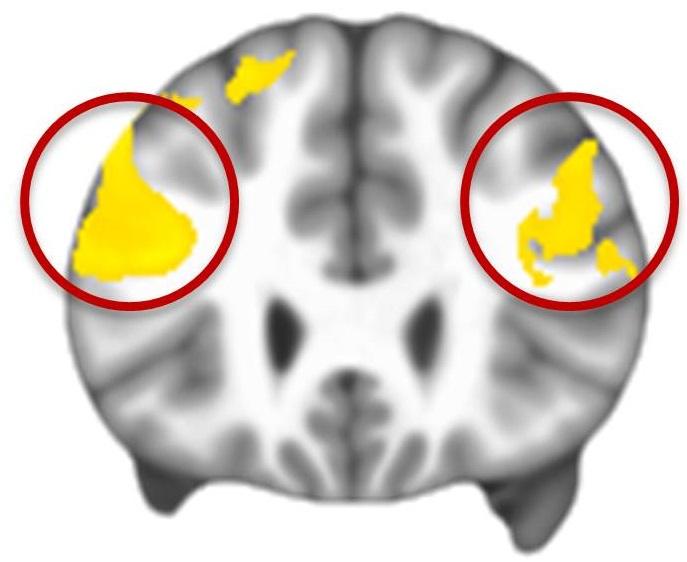MRIs link impaired brain activity to inabilit | EurekAlert!