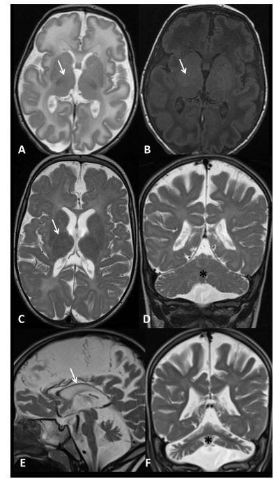 EPT1 Mutation Disrupts Myelina [IMAGE] | EurekAlert! Science News Releases