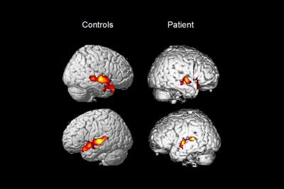 Exploring a Patient's Vegetative State | EurekAlert!