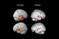 Exploring a Patient's Vegetative State | EurekAlert!