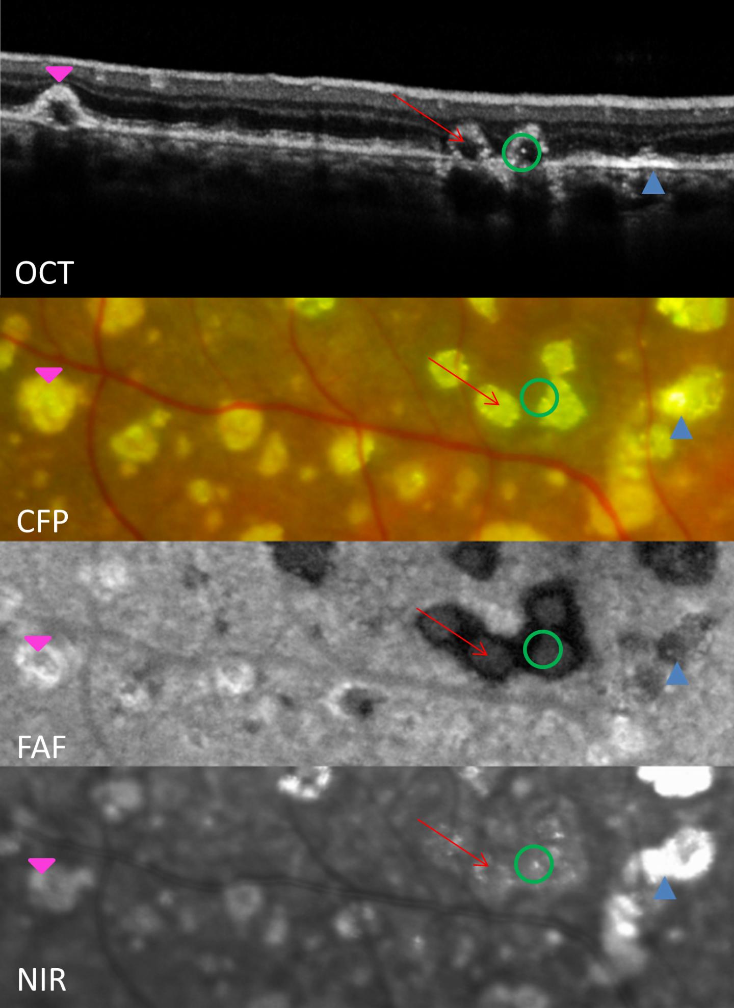 Calcified Eye Spots Linked to Progression of | EurekAlert!