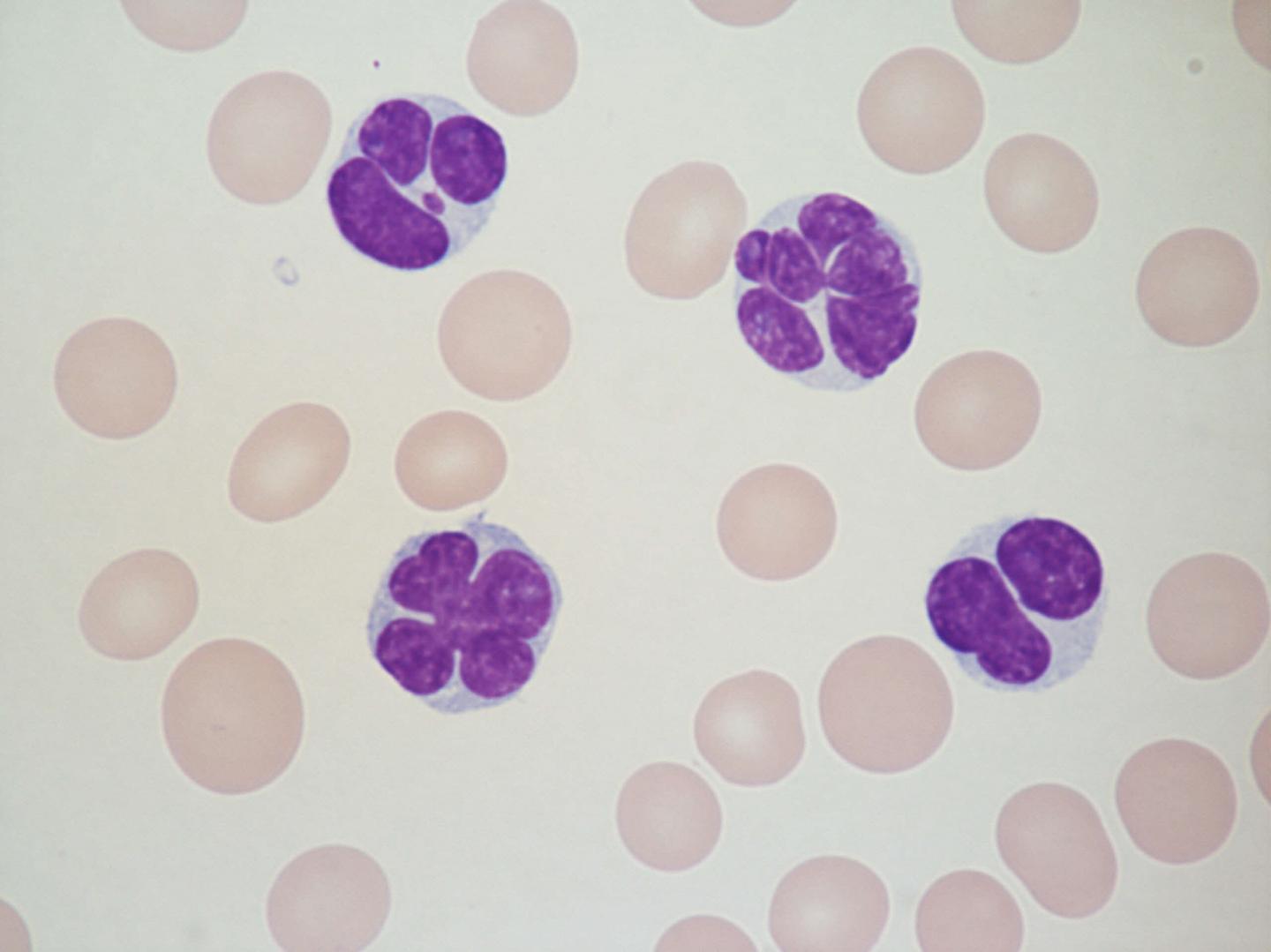 Anti-HIV Drug May Combat Adult Leukemia | EurekAlert!