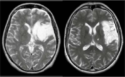 Lesion Left Brain Hemisphere [IMAGE] | EurekAlert! Science News Releases