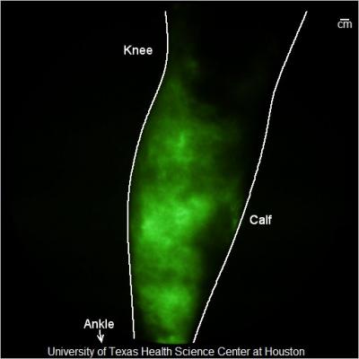Lower Leg Lymphedema [IMAGE] | EurekAlert! Science News Releases