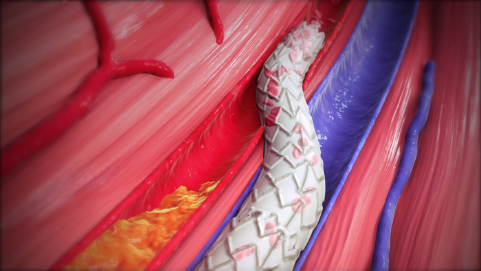 New procedure helps patients avoid leg amputa | EurekAlert!