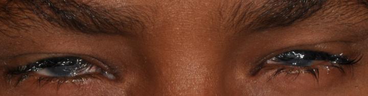 Trachomatous trichiasis surgery improves qual | EurekAlert!