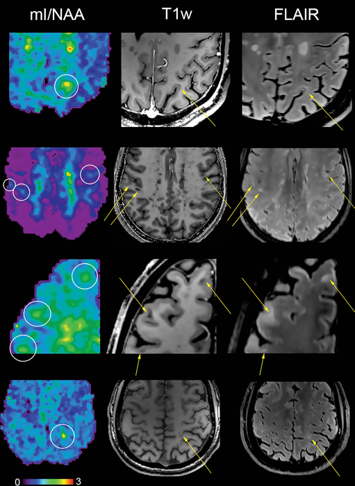 New MRI Technique Detects MS B [IMAGE] | EurekAlert! Science News Releases